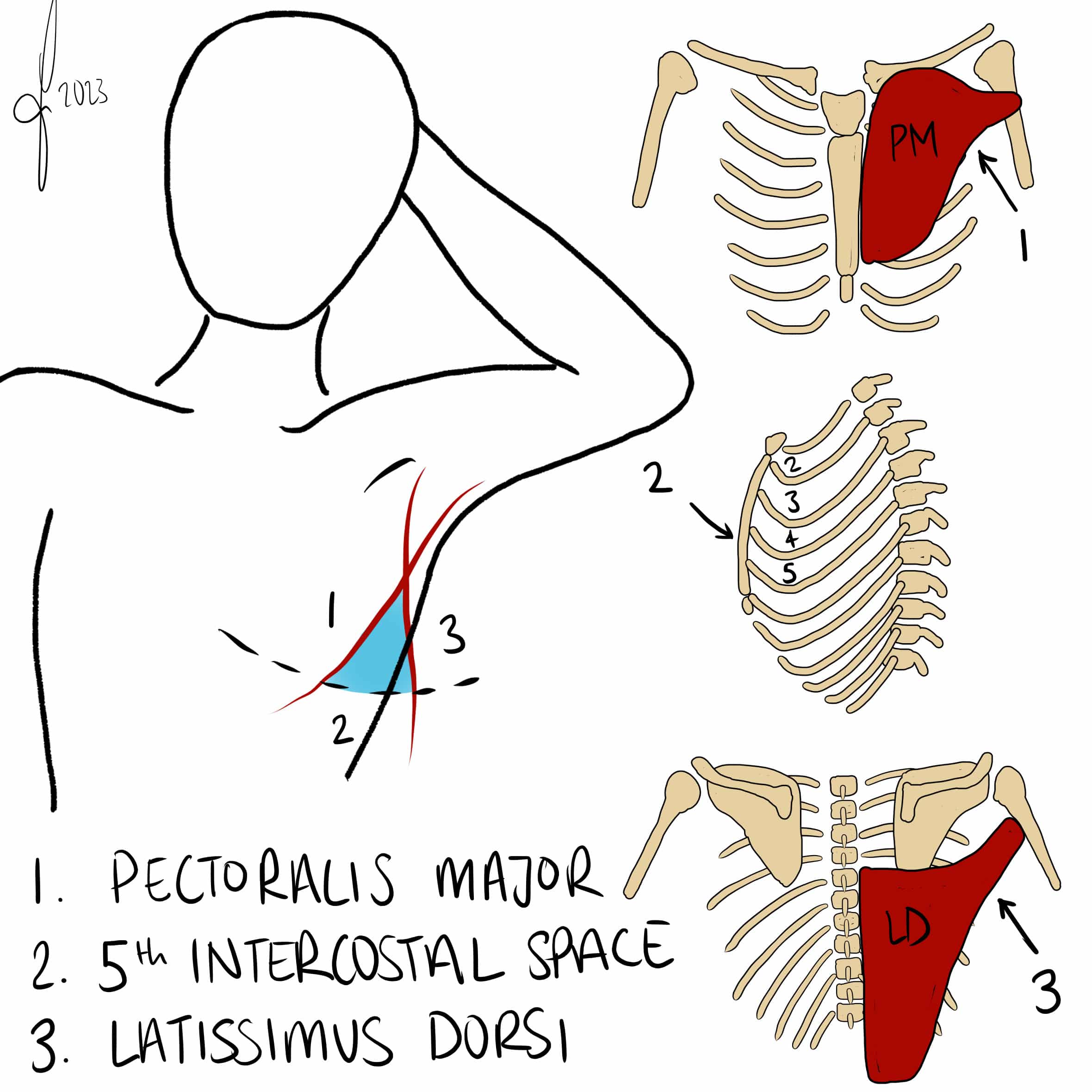 Tension Pneumothorax Treatment Spontaneous Tension Pneumothorax New